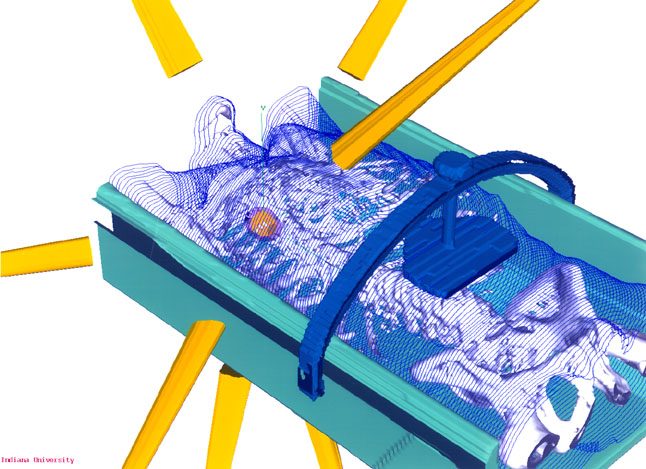 Stereotactic Body Frame | Lions Cancer Control Fund of Indiana