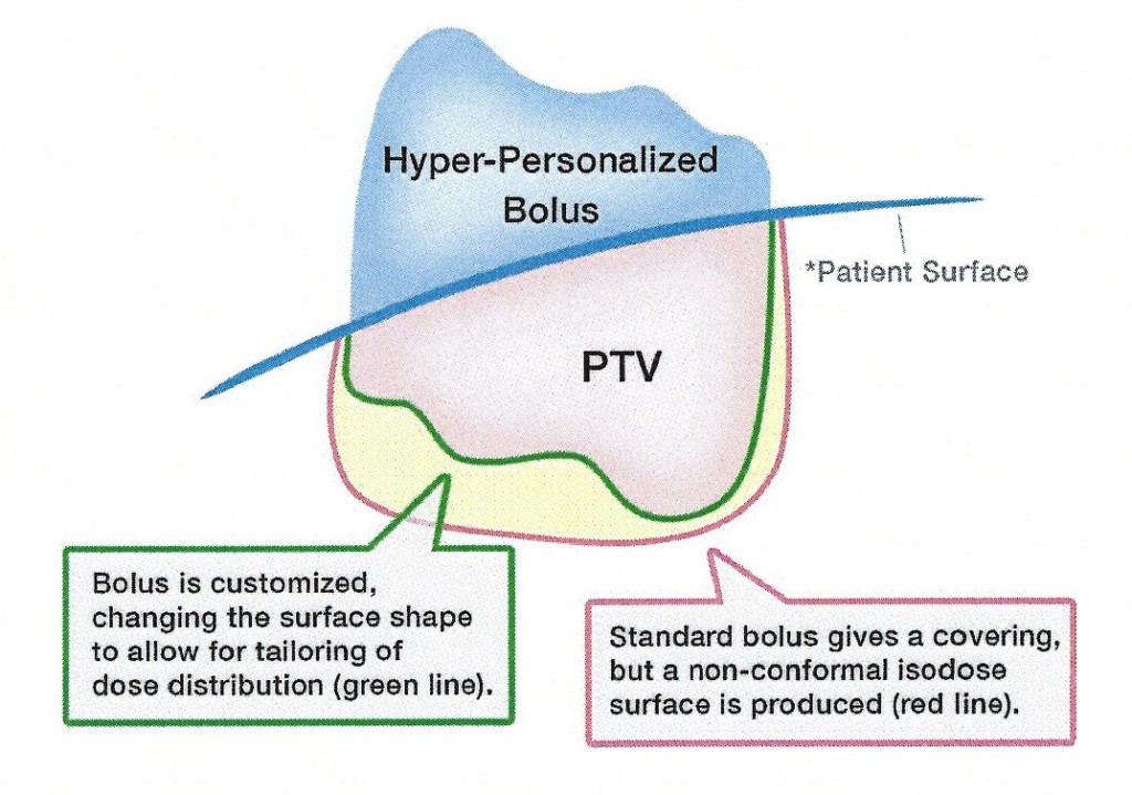 3D Printing Technology For Radiation Therapy Cancer Treatments | Lions ...
